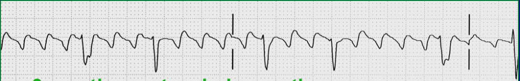 Atrial Flutter — 15 facts you may want to know. – Dr John M
