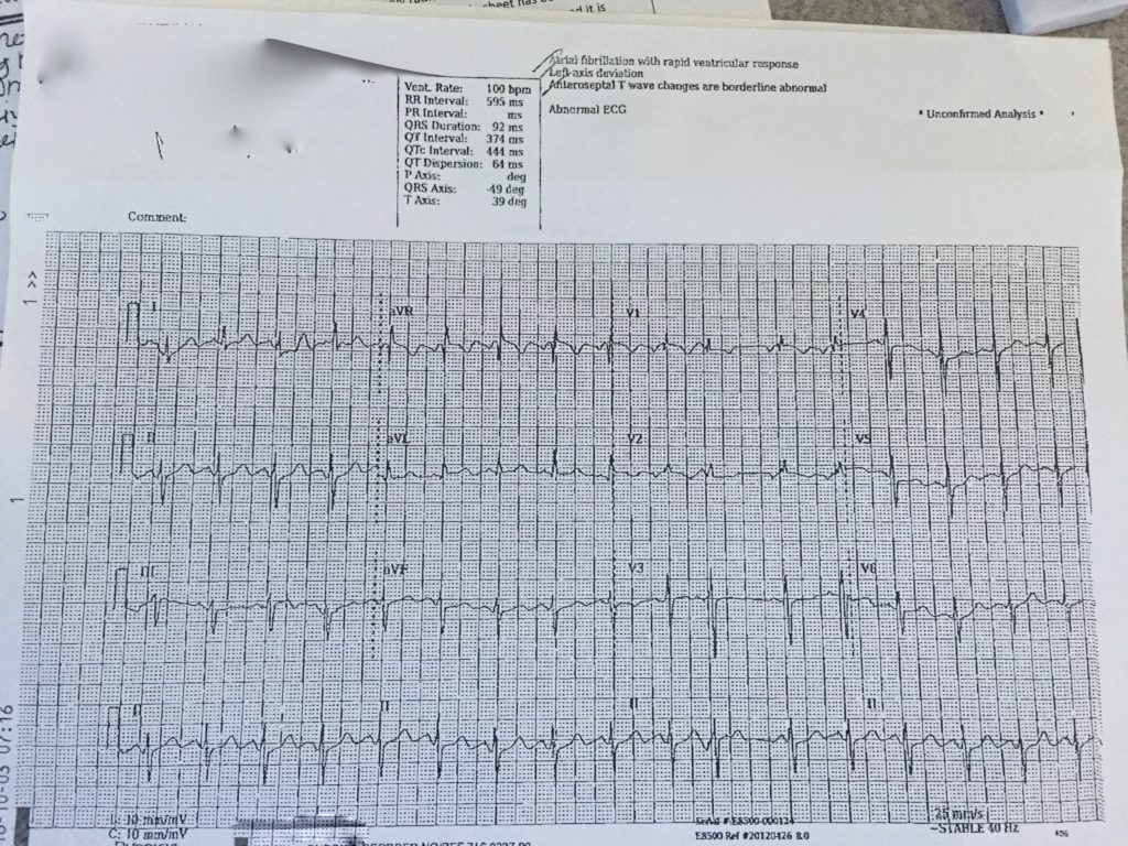 Fake Atrial Fibrillation — A Growing Patient-Safety Issue – Dr John M