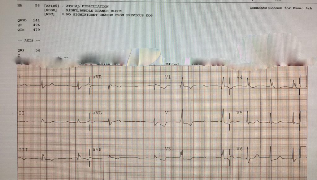 Fake Atrial Fibrillation — A Growing Patient-Safety Issue – Dr John M